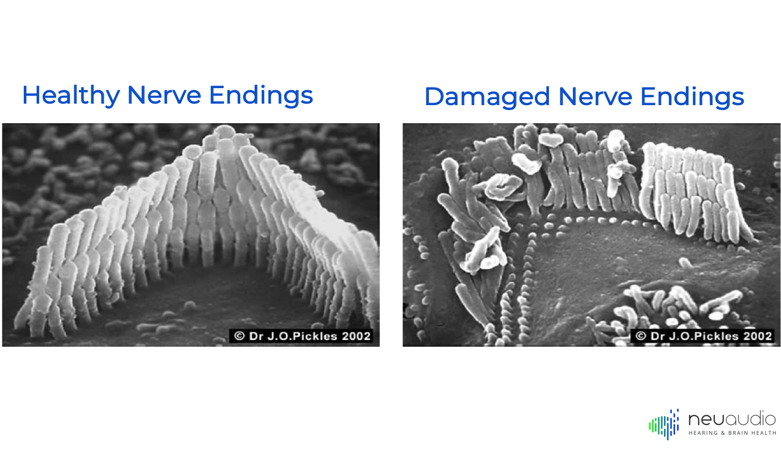 Sensorineural Hearing Loss - What's It All About? - Audiologist ...
